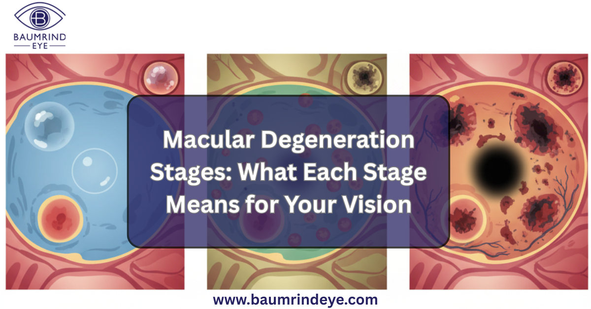 Macular Degeneration Stages What Each Stage Means for Vision
